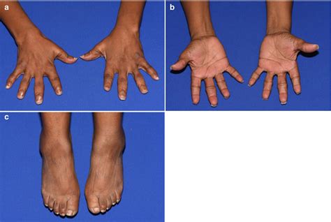 Physical Abnormalities 7 Celebrities With Physical Deformities