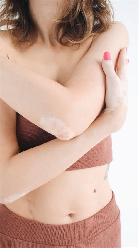A Woman Having Skin Discoloration On Her Hands Free Stock Video Footage Royalty Free 4k And Hd