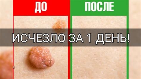 КАК УБРАТЬ папилломы или бородавки В ДОМАШНИХ УСЛОВИЯХ ЗА 1 ДЕНЬ Youtube