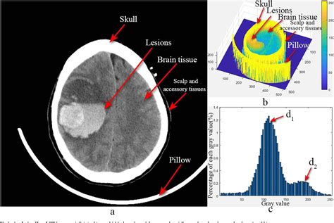 Figure 1 From Adaptive Mask Based Brain Extraction Method For Head Ct Images Semantic Scholar