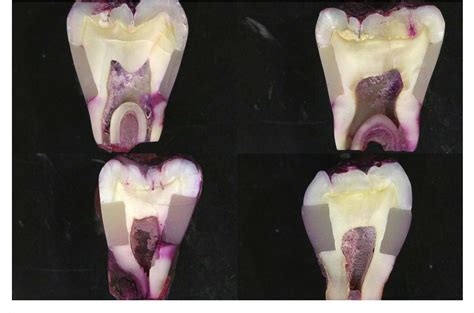 Figure 3 From Microleakage Around Class V Composite Restorations After Ultrasonic Scaling And