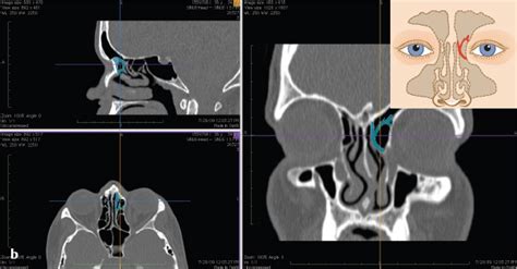 Approaches To The Frontal Sinus Ento Key