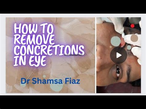 How To Remove Conjunctival Concretions In Simple Way Youtube