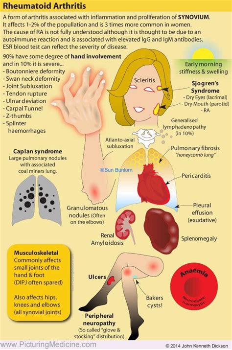 🔶 Rheumatoid Arthritis Summary ️ Manual Of Medicine Facebook