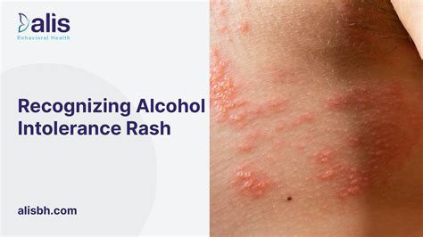 Recognizing Alcohol Intolerance Rash Alis Behavioral Health