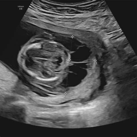 Cystic Hygroma At 14 1 Weeks Gestation Download Scientific Diagram