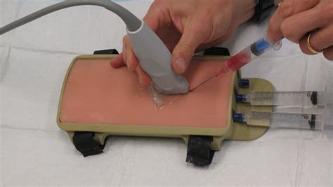 Complete Guide To Peripheral Iv For Er Patients Hospital Procedures Consultants