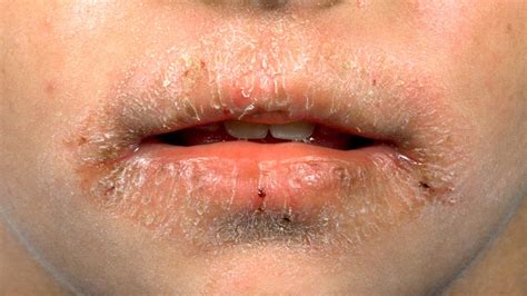 What Causes Fungus On Your Lips
