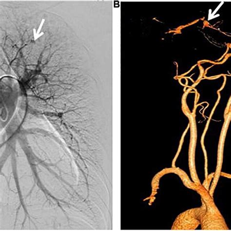 Pulmonary Angiography And Cranial Computed Tomographic Angiogram A Download Scientific