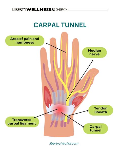 Carpal Tunnel Syndrome Treatment Liberty Wellness And Chiro