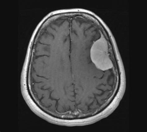 Left Temporal Meningioma