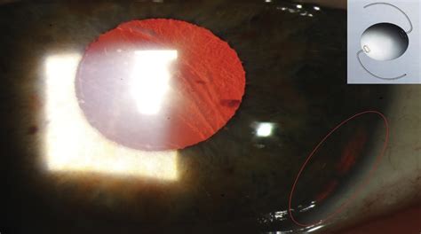 Peripheral Iris Transillumination Defect And Recurrent Anter Journal Of Cataract