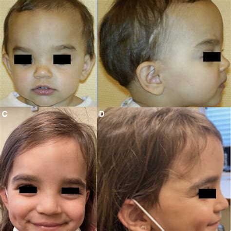 Pictures Of A Patient Presenting A Non Syndromic Scaphocephaly Before Download Scientific