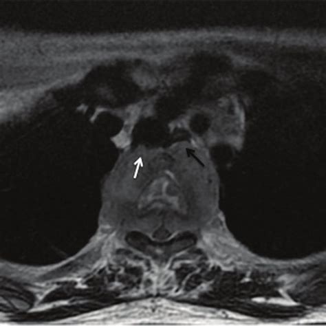 Axial T2 Fat Suppressed Mr Image At The Level Of T3 Showing A Download Scientific Diagram