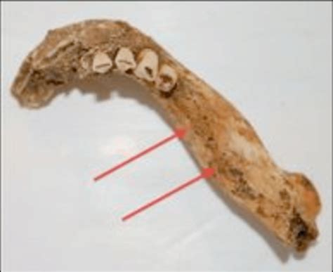 8 Antemortem Loss Of The Posterior Teeth On The Mandible Arrows