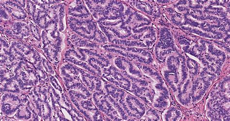 Carcinoid Syndrome Histology