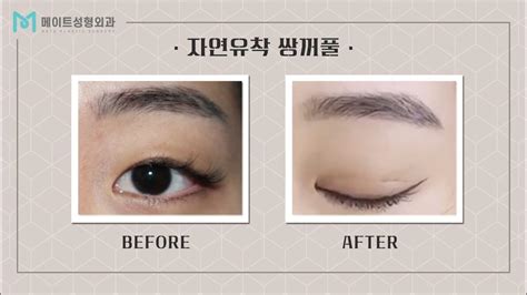 겨울방학에 눈성형 고민하고 있다면 자연유착쌍꺼풀 후기 Youtube