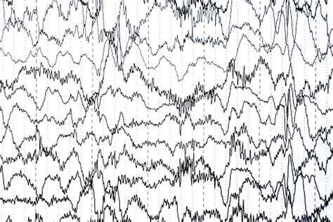 Brain Wave Patterns On Electroencephalogram Eeg Of The Pediatric Patients Problems In The