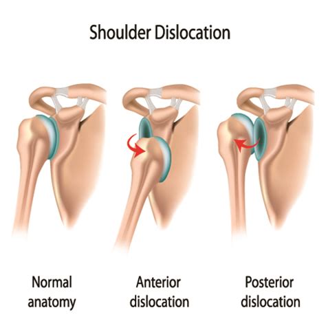 Shoulder Dislocation Core Em