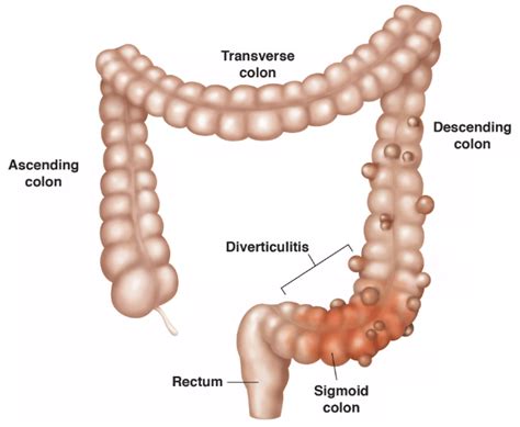 Colon Sigmoide