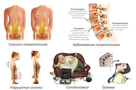 Протрузия дисков позвоночника симптомы и лечение