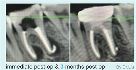 C Root Sp Strontium Based Bioceramic Root Canal Sealer C Root Dental Medical