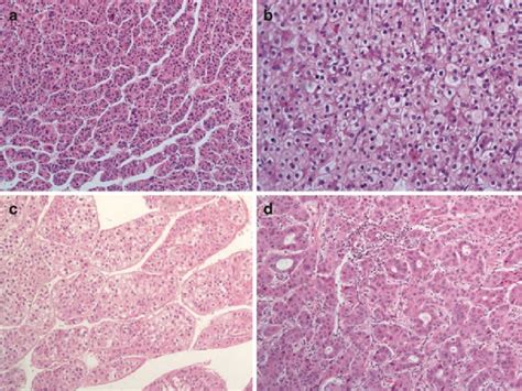 4 Main Histological Pattern Of Hepatocellular Carcinoma A Download Scientific Diagram