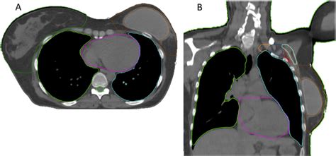 A Computed Tomography Axial Slice Showing The Consensus Delineation