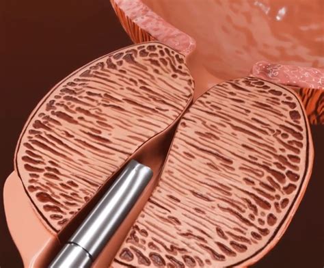 전립선결찰술 프로게이터 신도림 비뇨기과 닥터유비뇨기과