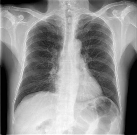 Chest Radiographs Show No Obvious Substantial Lesions In Both Lungs Download Scientific Diagram