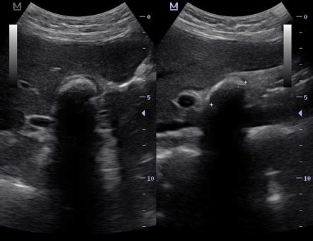 Wall Echo Shadow Sign Ultrasound Radiology Reference Article