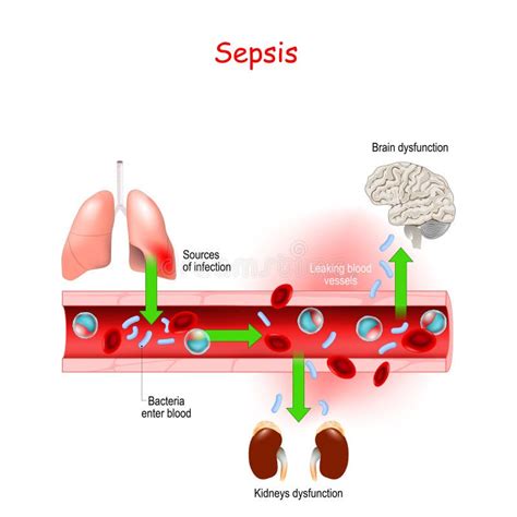 Sepsis Stock Illustrations 2 338 Sepsis Stock Illustrations Vectors