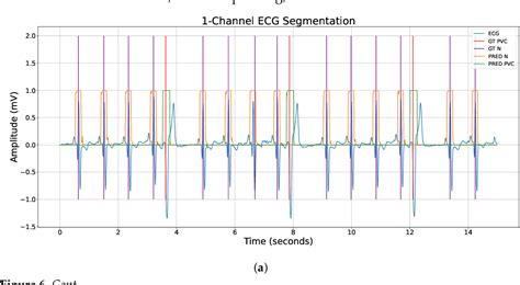 Figure 1 From End To End Premature Ventricular Contraction Detection Using Deep Neural Networks