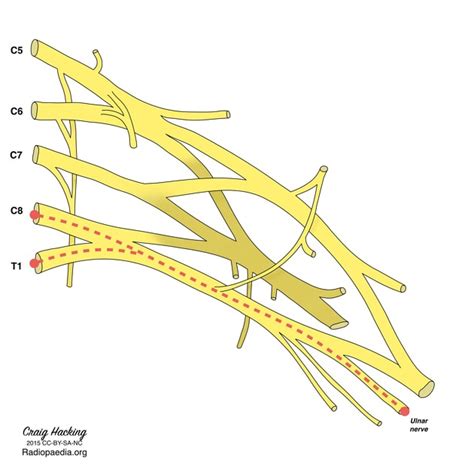 Ulnar Nerve Brachial Plexus