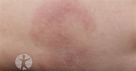 Erythema Chronicum Migrans Image