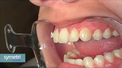 Symetri Clear™ Aesthetic Twin Brackets Ormco Supplies