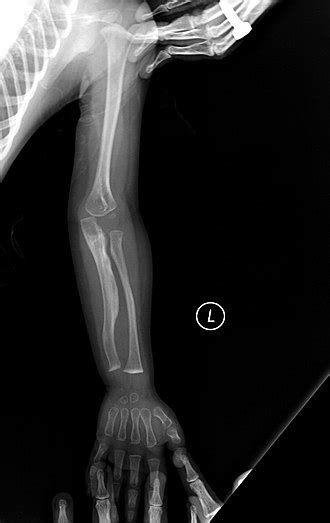Pathologie Knochen Wikibooks Sammlung Freier Lehr Sach Und