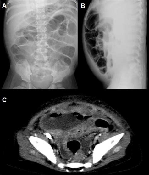 X Ray Scans A Supine View B Cross Table Lateral View And Computed Download Scientific