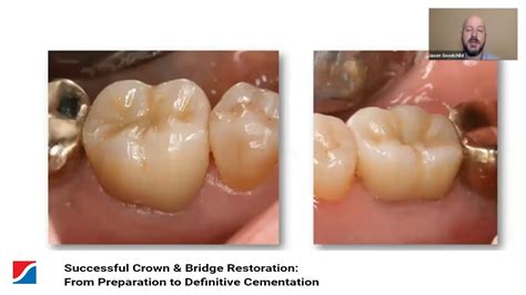 Successful Crown And Bridge Restoration From Preparation To Definitive