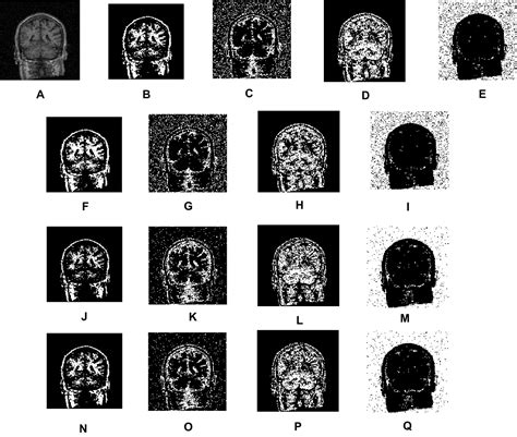 Frontiers Conditional Spatial Biased Intuitionistic Clustering Technique For Brain Mri Image