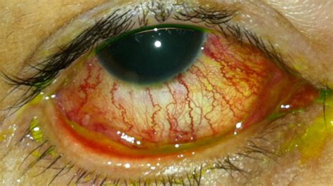 Ppo3 Lecture 11 Gonio 3 Normal Vs Abnormal Findings Flashcards Quizlet