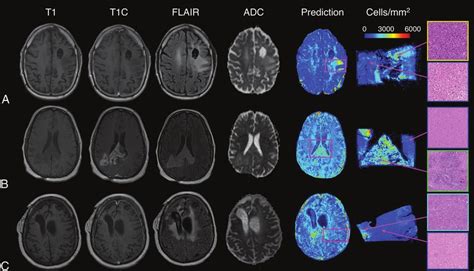 Radio Pathomic Maps Of Cell Density Identify Brain Tumor Invasion