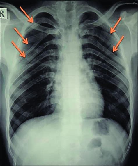 What Is A Bifid Rib At Christopher Doyle Blog