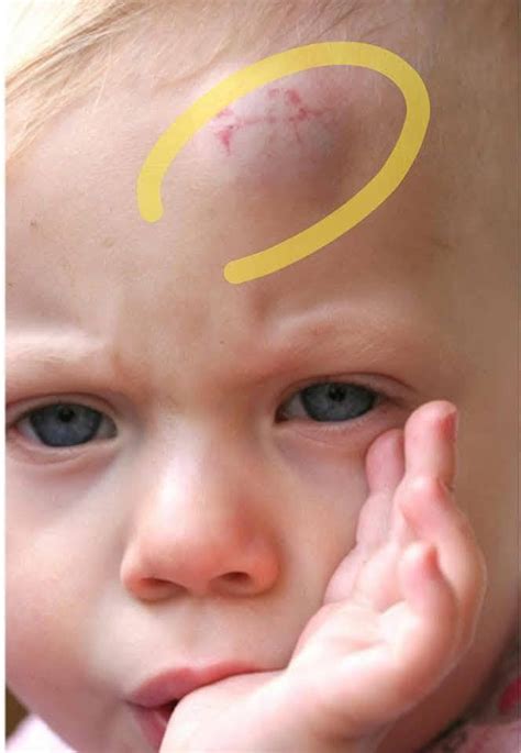 Happy දරුවකුගේ ඔලුව වැදී ගෙඩි ගැසුන විට කල යුතු හා නොකළ දේ Dr Roshan Piyarathne Mbbs Md