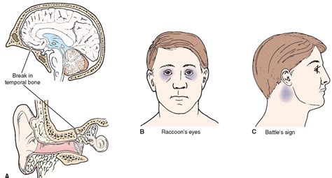 Basilar Skull Fracture Raccoon Eyes