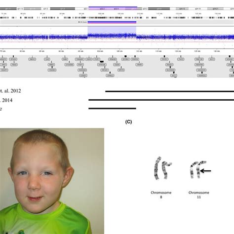 A Chromosomal Microarray Depicting The 125 Mb Duplication Of Download Scientific Diagram