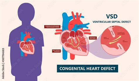 Cath Lab Atrial Septal Defect Tetralogy Of Fallot Patent Foramen Ovale Mitral Valve Stenosis