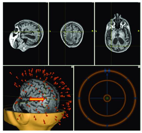 Individual Navigation Nexstim On Left Angular Gyrus Download