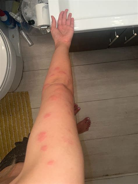 How To Identify 10 Of The Most Common Bug Bites All Easy Recipes
