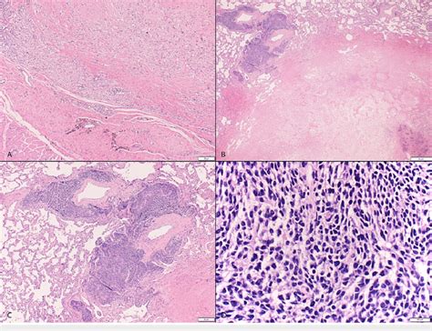 Resected Forearm Nodule Status Post Cavimv Chemotherapy Resected